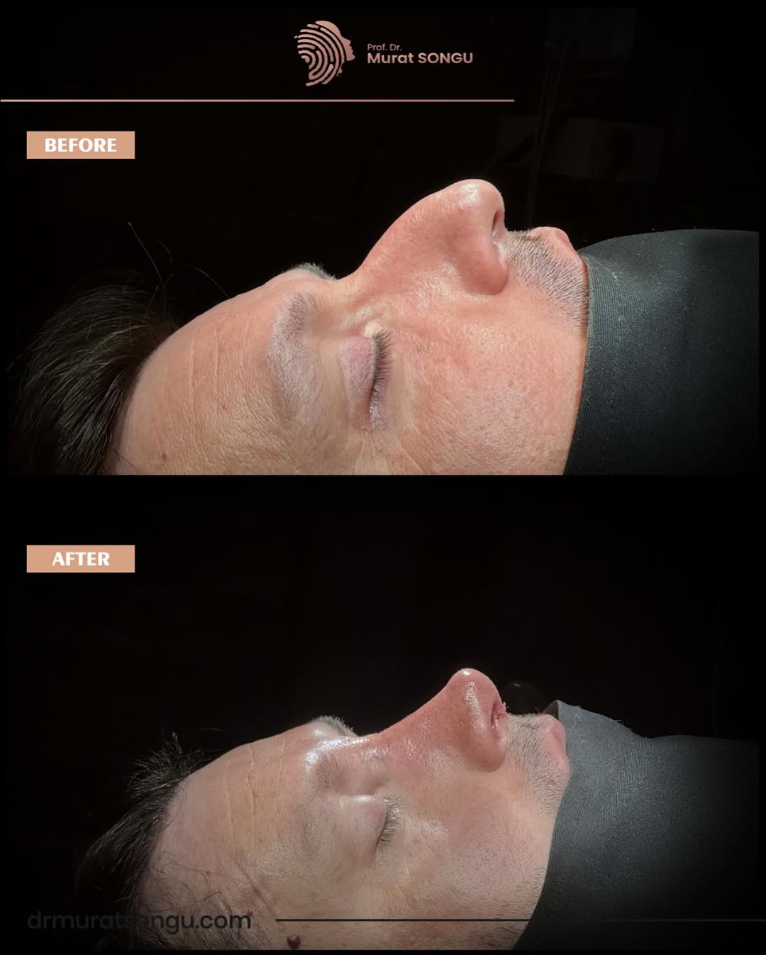 Roman Nose Job Before And After - Prof. Dr. Murat Songu